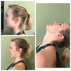 Cervical Retraction with Extension - Wheaton, IL Chiropractor